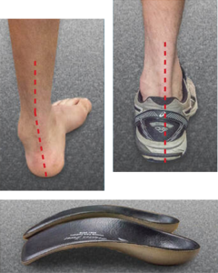 Supinated foot | Stephen Zucal South Perth Podiatrist